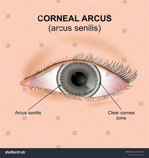 Corneal Arcus Arcus Senilis Eye Illustration Stock Illustration