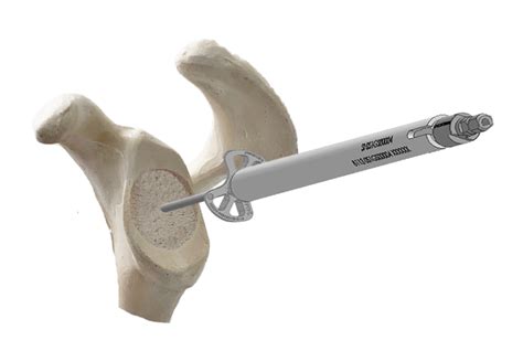 Augmented Glenoid Inset™ Plus From Shoulder Innovations