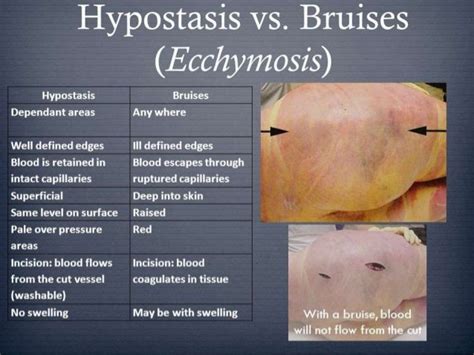 Ecchymosis Vs Bruise