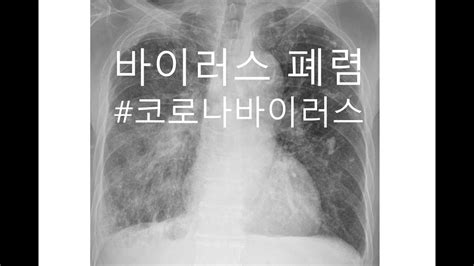 바이러스 폐렴 코로나바이러스 우한폐렴 Youtube