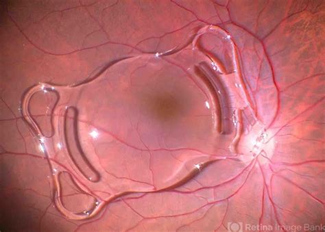 Dislocated Iol Retina Image Bank
