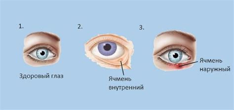 Заразен ли ячмень на глазу для окружающих: как передается заболевание у ...