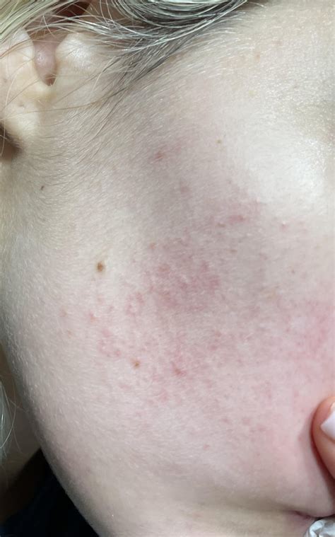 Sunscreen And Dermatitis R Dermatologyquestions