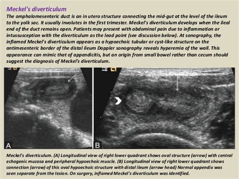 Presentation1 Pptx Ultrasound Examination Of The Appendix