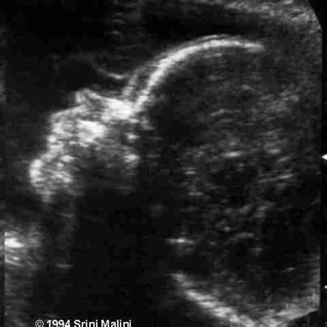 📃 Thanatophoric Dysplasia In Monozygotic Twins