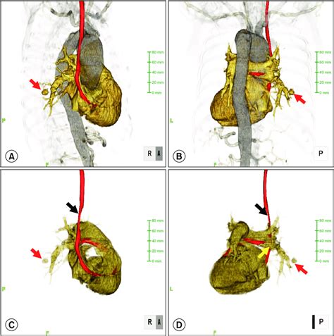 Reconstructive 3d Visualization From The Postsurgical Ct Scan A