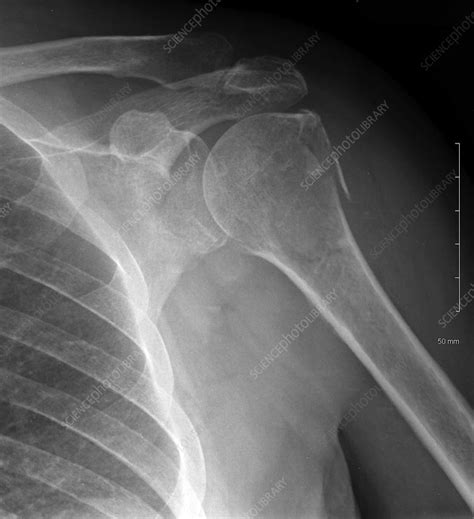 Shoulder Fracture X Ray Stock Image C039 3348 Science Photo Library