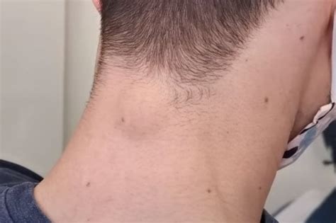 Neck Cyst Incision And Drainage Rpimplepopperdelight