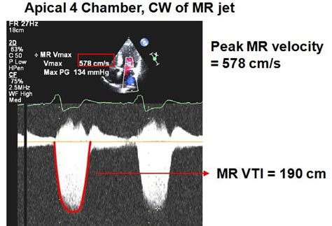 194 Best Echo Images On Pinterest Medicine Ultrasound And Cardiac