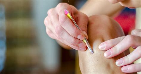Ingrown Hair Cyst Treatment Artofit