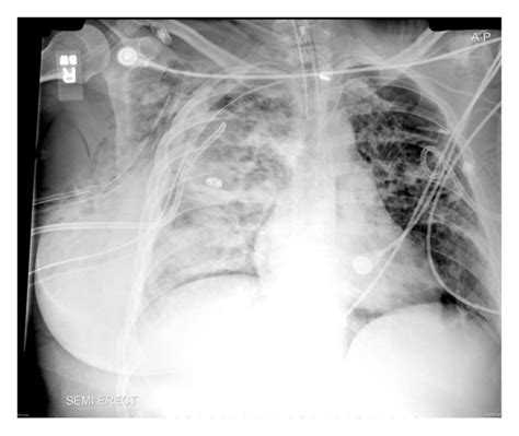 Chest X Ray Of An Ards Victim Who Has Developed Multiple Pneumothoraces