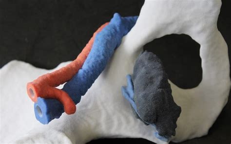 3d Printed Model Of Pelvic Tumor For Surgical Planning 3d4med