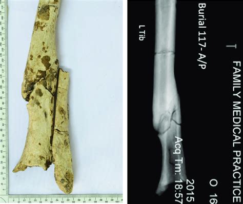 Left Tibia And Fibula Distal Half Of Diaphysis Anterior View And