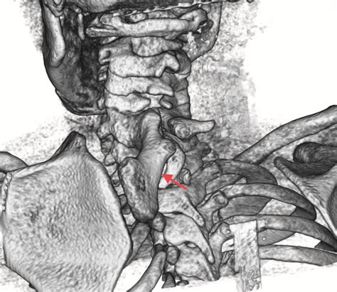 Os Omovertebrale A Congenital Deformity Eurorad