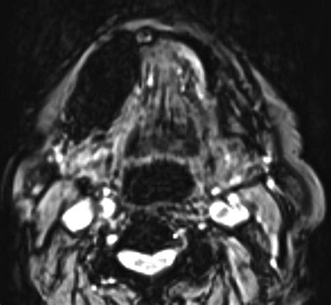 75 Year Old Woman With Right Mandible Cystic Lesion And Primary