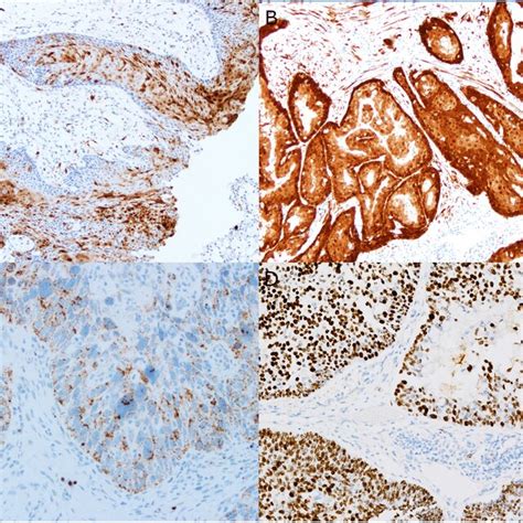Immunohistochemical And In Situ Hybridization Studies Showing Positive