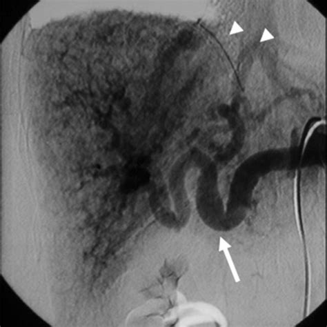 Celiac Angiogram Obtained During Early Arterial Phase Shows Tortuous Download Scientific