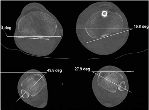 Figure 1 From Prevalence Of Rotational Malalignment After Infrapatellar