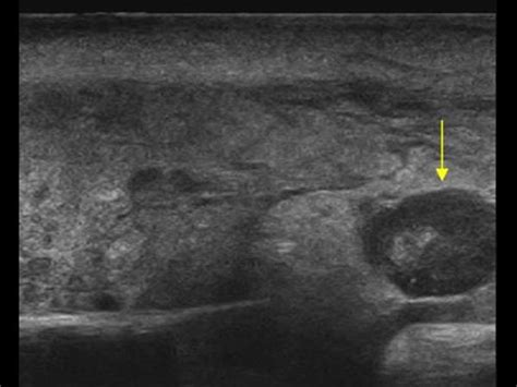 Head And Neck 4 3 Salivary Glands Case 4 3 2 Salivary Gland