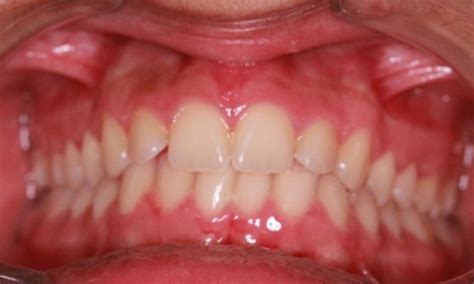 Case 3 Midline Shift