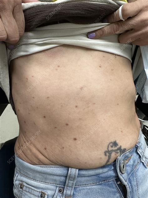 Lymphoma Rash Stock Image C0606928 Science Photo Library
