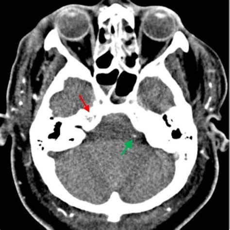 Axial Ct Angiography Of Intracranial Arteries In Two Different Levels