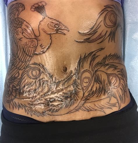 Tummy Tuck Tattoo Cover Up