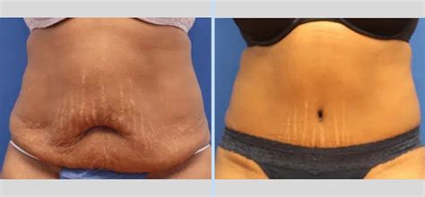 Tummy Tuck Before And After Photos Main Line Plastic Surgery