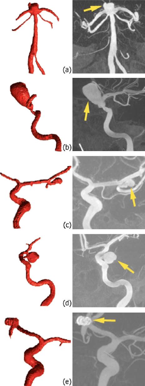 Figure 10 From Computer Assisted Extraction Of Intracranial Aneurysms