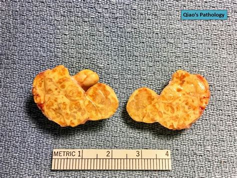 Giant Cell Tumor Gross