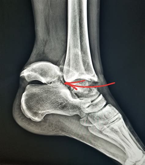 Life After A Calcaneus Fracture Surgery Make A Major Record Efecto