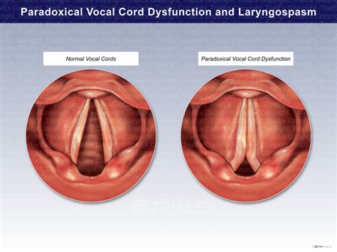 Vocal Cord Dysfunction Vocal Cord Paralysis Voice Box Disorder
