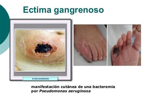Ectima Gangrenoso Pseudomonas Pseudomonas Skin Infections