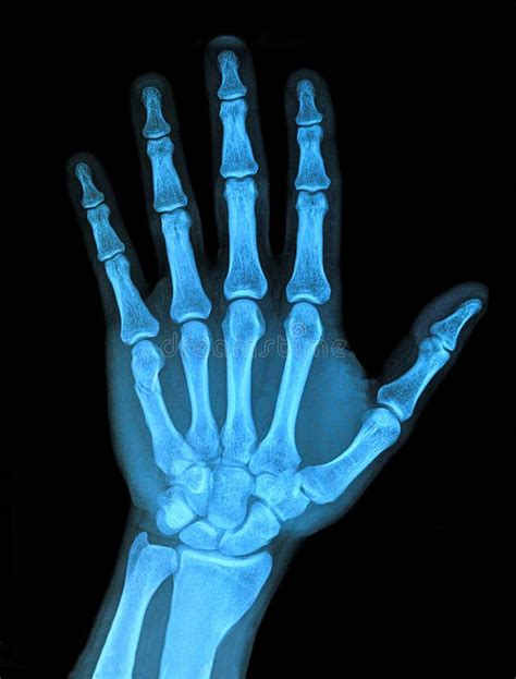 Hand Xray