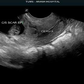 Case 1 Transvaginal Sonograph Shows Cesarean Section Scar Implantation