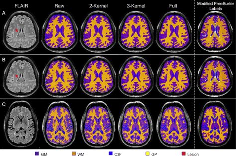 Qualitative Comparison Of C DEF Models Representative 3D FLAIR Axial