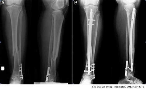 Fractura De La Tibia Y Perone Quotes Trendy New