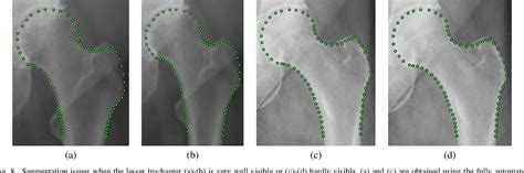 Figure 3 From Fully Automatic Segmentation Of The Proximal Femur Using