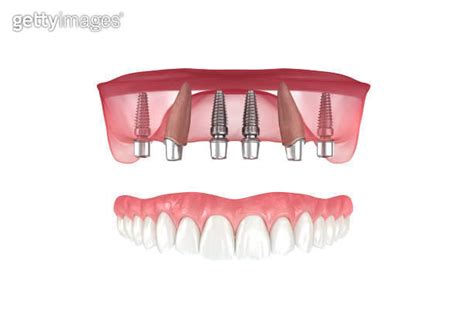 Maxillary Prosthesis Supported By 2 Teeth And 4 Implants Medically