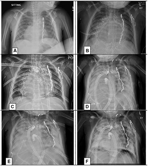 Dendriform Pulmonary Ossification Postpediatric Cardiac Surgery A Case