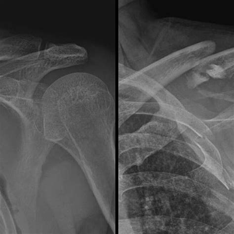 Pooled Rate Of Coracoid Or Clavicle Fracture Download Scientific Diagram