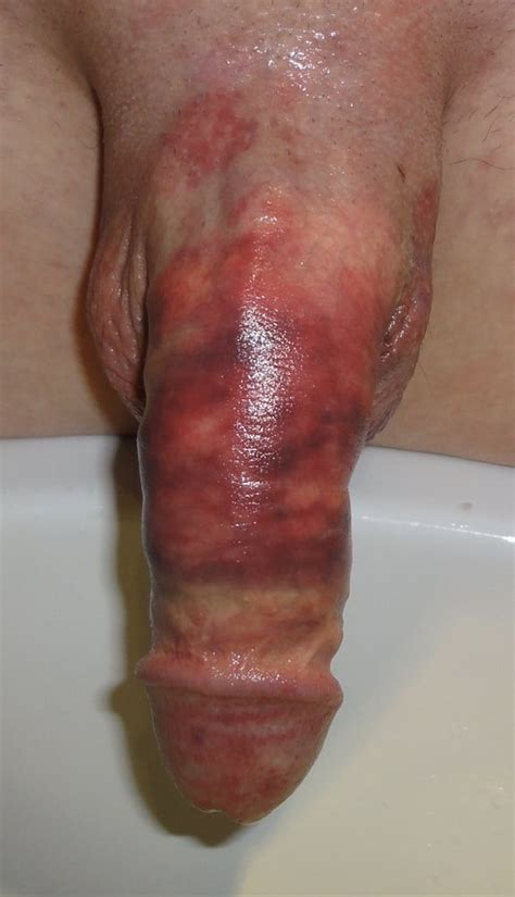 Cock Crushed Porn Pictures Xxx Photos Sex Images 4049982 Pictoa