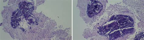 The Histological Findings Include Central Calcification With Download Scientific Diagram