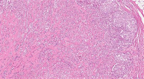 Intraductal Carcinoma Of The Salivary Glands Ottawa Atlas Of Pathology