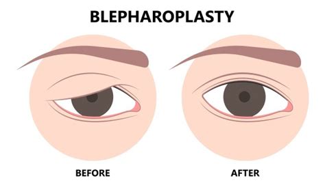 Dermatochalasis And Blepharoplasty Meadows Eye Physicians And Surgeons