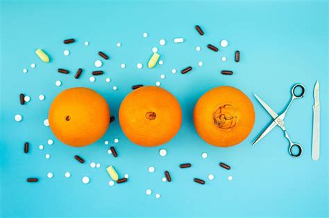 Operación De Hemorroidectomía