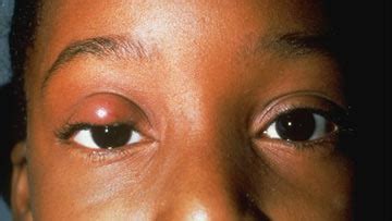 Styes And Chalazion South Bay Ophthalmology