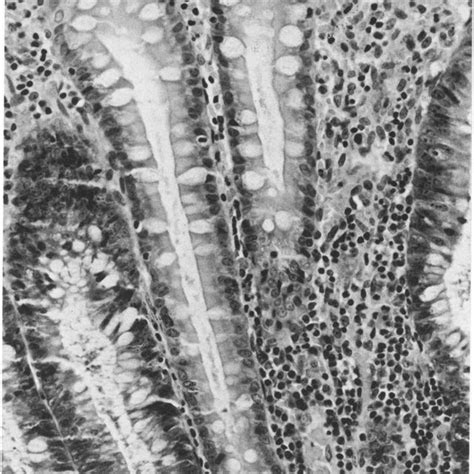 Hyperplastic Mucosa The Epithelium Shows Tall Columnar Cells With A