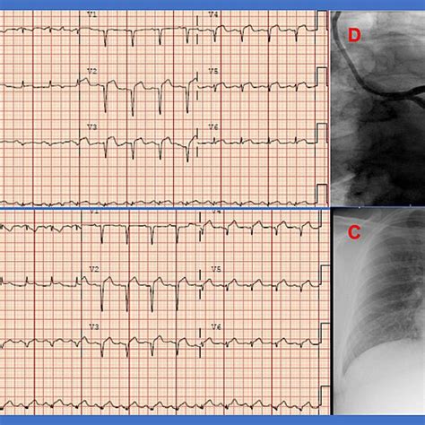 A Diffuse St Segment Elevation B Ekg One Hour Later Showed No Download Scientific Diagram