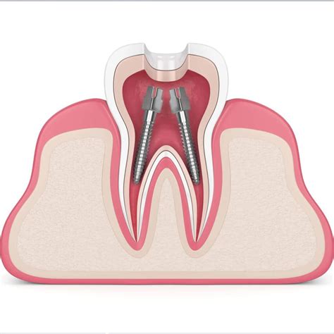 Root Canals What To Expect Before During And After